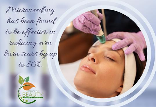 Platelet Rich Plasma (PRP) Face Treatment/Microneedling - Essence of ...